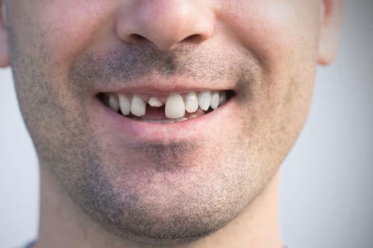 Japanese Scientists Begin Human Trials of TRG-035 to Regrow Real Teeth ...