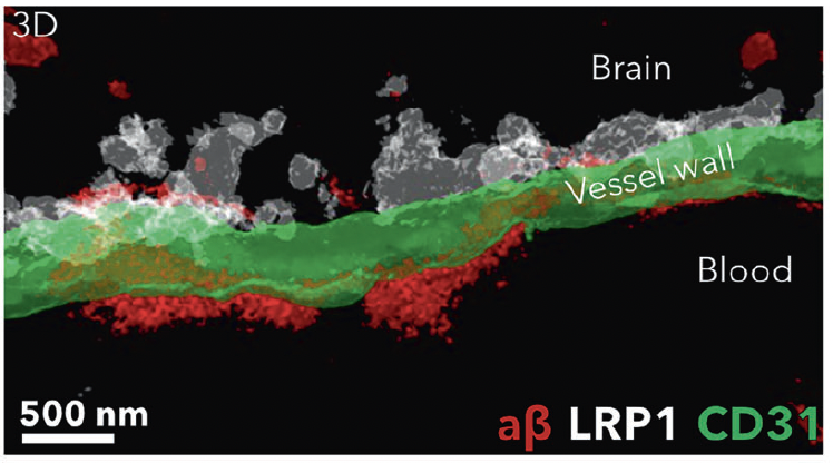 New Alzheimer's Treatment Clears Brain Plaques In Hours, Restores ...