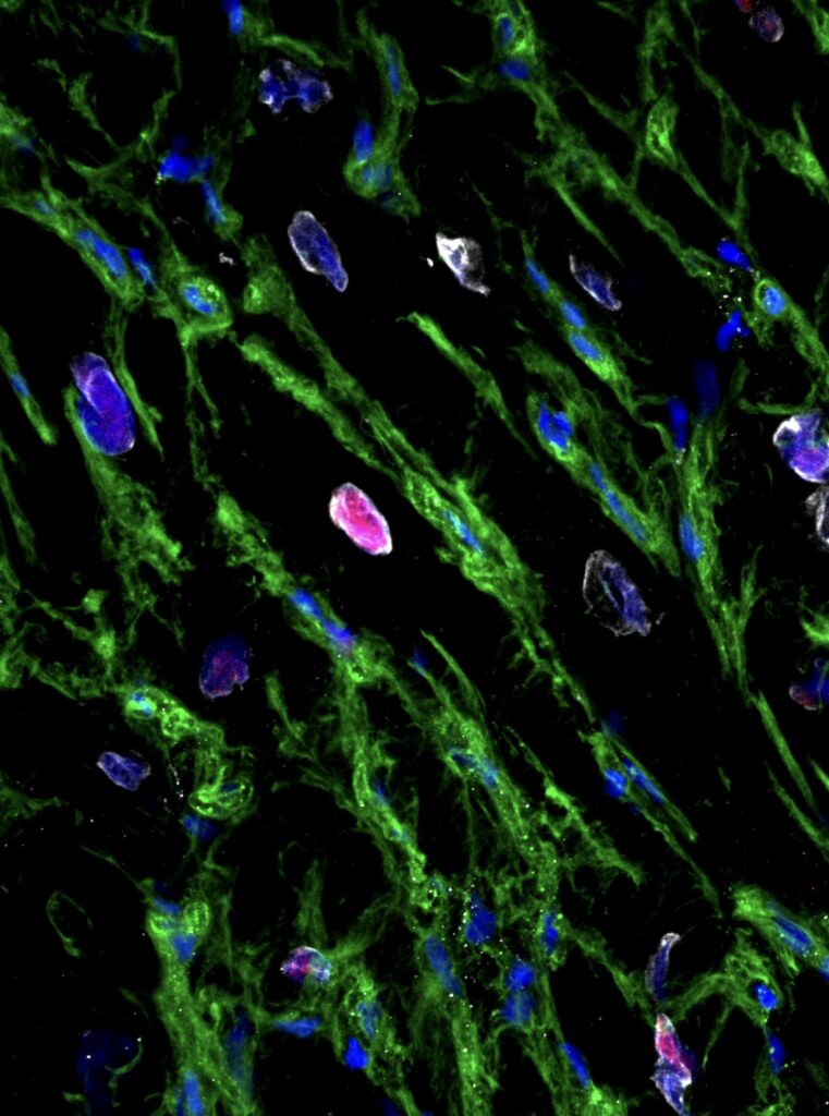 Human Heart Can Regrow Muscle After a Heart Attack, Australian Study ...